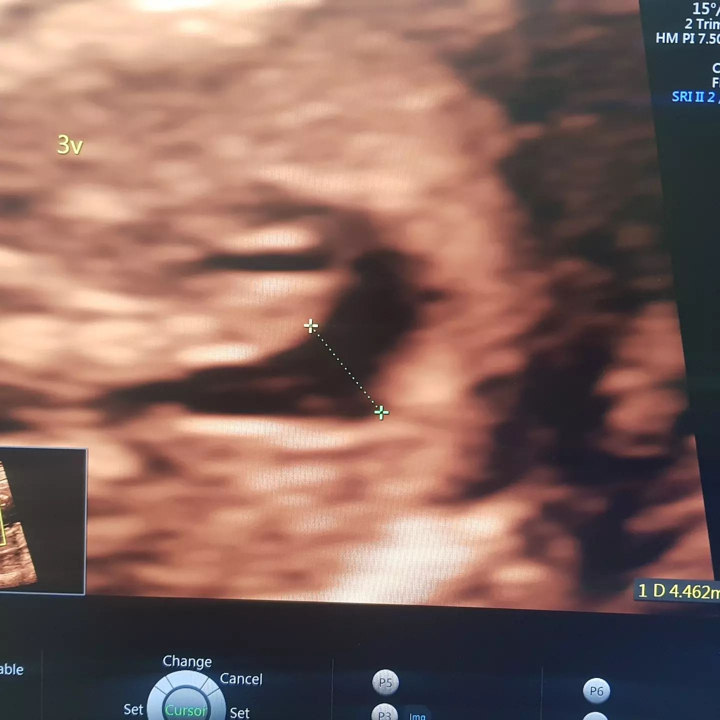 ناهنجاری تنه واحد شریانی یا Common Trunk قلب جنین چیست - دکتر رضا گرامی